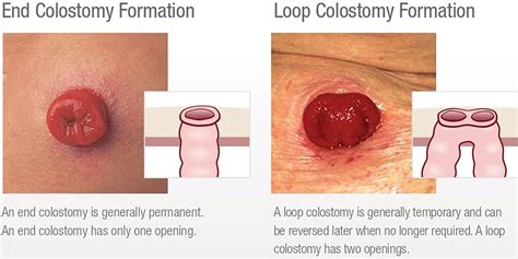What Is An Ostomy Types Of Ostomies Ostomy Canada Society