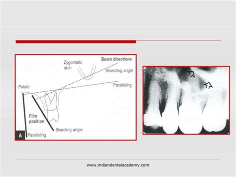 Bisecting Angle Vs Paralleling Technique Orthodontic Courses By Indian Dental Academy