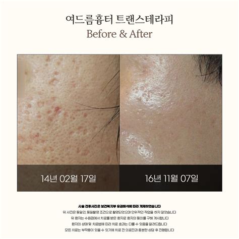 후한의원 수원 후한의원 여드름흉터 치료가 Why 어려운가요🙋🏻‍♀️ 바로 피부 진피층까지 손상을 입으면 정상피부조직으로 회복이 어렵기 때문입니다 하지만 후한