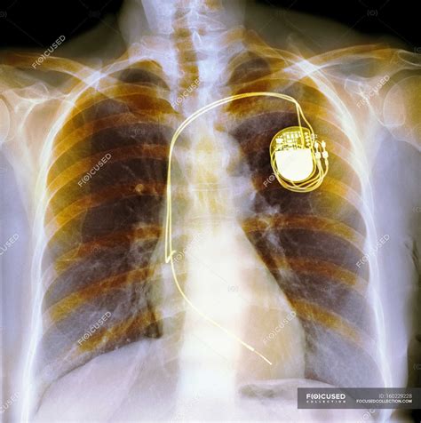 Pacemaker Defibrillator Battery Life At Janelle Hernandez Blog