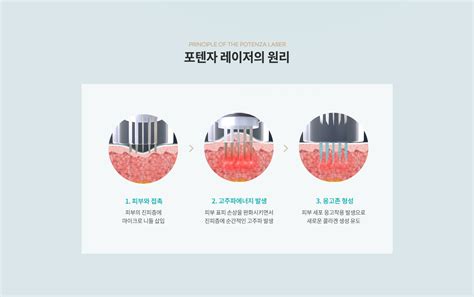 포텐자 레이저 강남본점