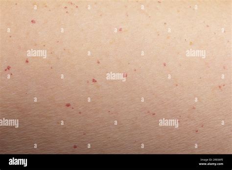 Red Age Spots