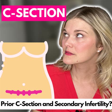 C Section And Infertility Does A Prior C Section Increase Your Risk Of Secondary Infertility