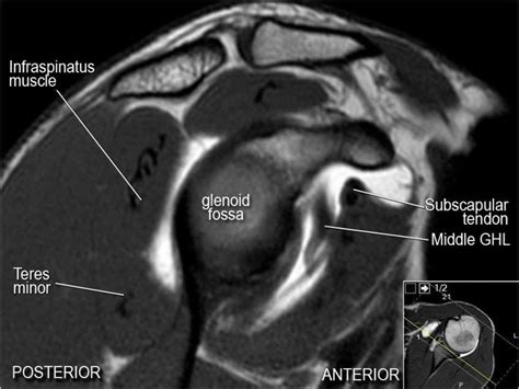 Mri Anatomy Of Shoulder At Leonard Kaminski Blog