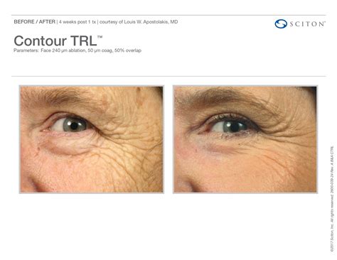 Contour Trl In Florence Ky Erbium Yag Laser Treatment