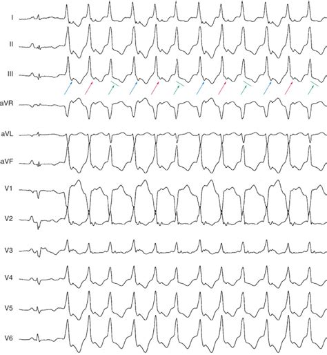 Wide Complex Tachycardias Thoracic Key
