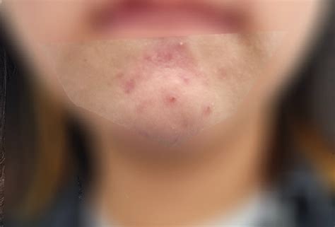 더쿠 턱드름 이렇게 나는거 무슨 문제일까 사진