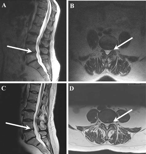 Disc Herniation L4 L5 All About L5 S1 Lumbosacral Joint Pnswg