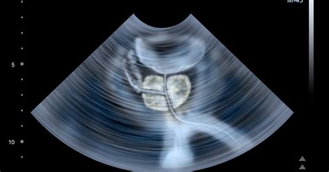 Prostate Stones Prevention And Treatment