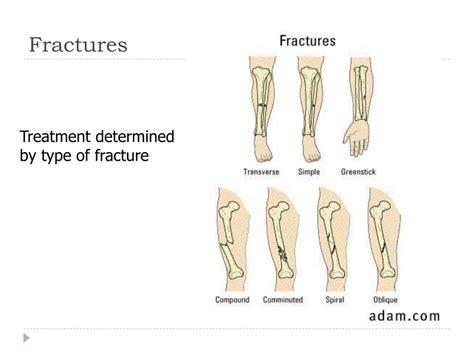 Ppt Pediatric Fractures Types Treatments And Complications