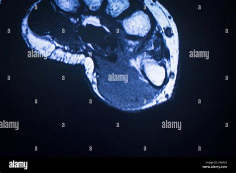 Mri Magnetic Resonance Imaging Medical Scan Test Results Of Foot And