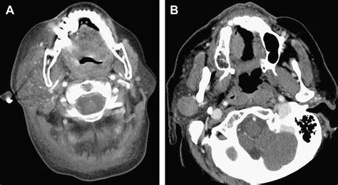 The Diagnosis And Management Of Parotid Disease Oral And Maxillofacial Surgery Clinics