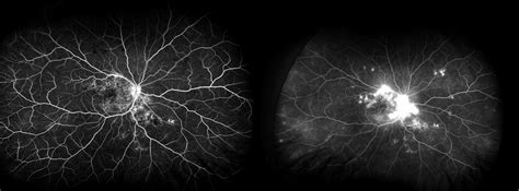 Octcases Uveitis Case 16