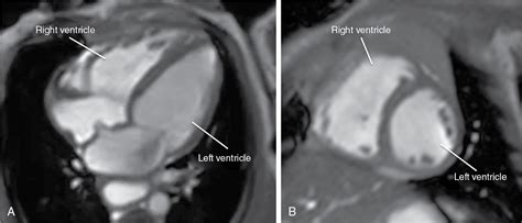 Cardiac Magnetic Resonance Imaging In The Assessment Of Systemic And