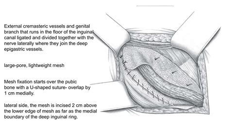 Management Of Groin And Abdominal Wall Herniaspptx