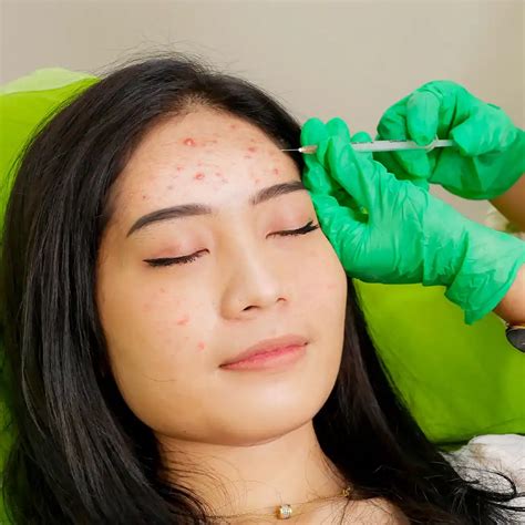 Treatment Injeksi Acne Eterniskin