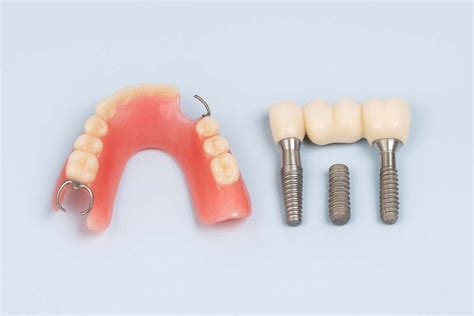 Dental Implants Or Partial Denture When To Choose Which Solution