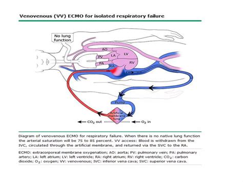 ECMO PPTX Heart And Cardiovascular Diseases Diseases And Conditions