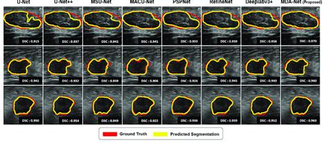 Breast Lesion Segmentation Result Of Three Randomly Selected Samples Download Scientific