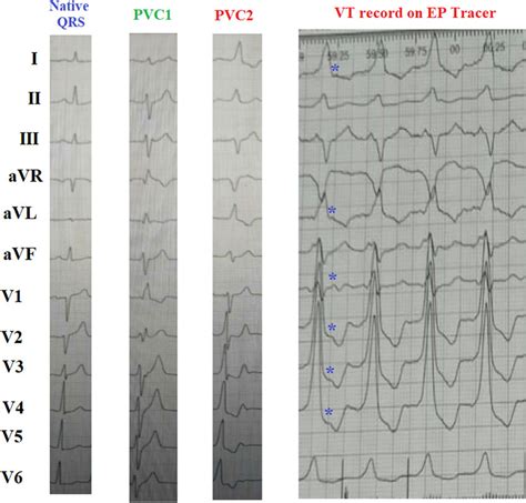 Two Different Pvc Morphologies Seen In The Superficial Ecg Recording Of Download Scientific