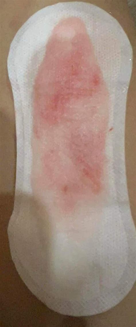 Is This Implantatiom Bleeding Rpregnancycare