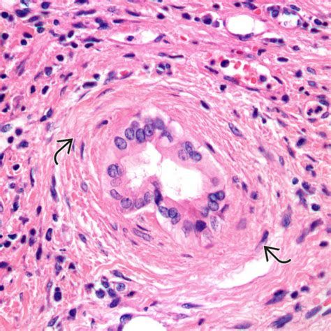 Ischemic Cholangitis Basicmedical Key