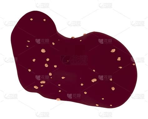 肝与肝细胞癌，肝上恶性结节。医学科学与研究概念