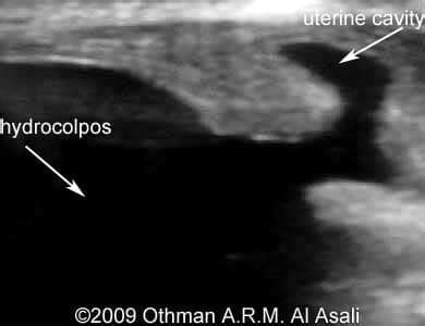 📃 Persistent Urogenital Sinus With Hydrometrocolpos