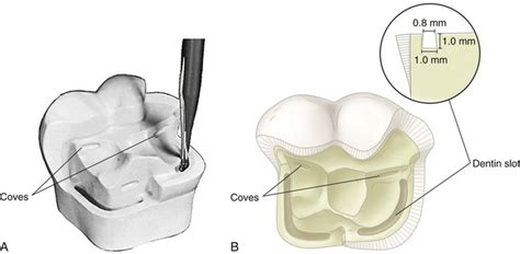 16 Complex Amalgam Restorations Pocket Dentistry