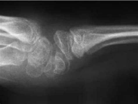 Ap View A And Lateral View B Kirschner Wire Fixation