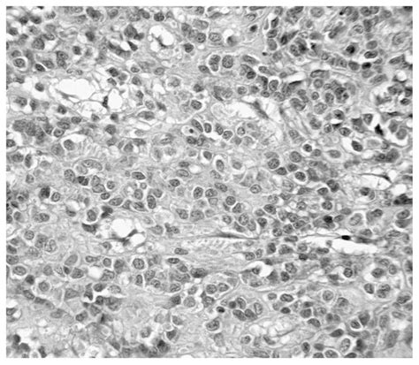Platelet Derived Growth Factor Receptor Alpha Pdgfra Mutant Download Scientific Diagram