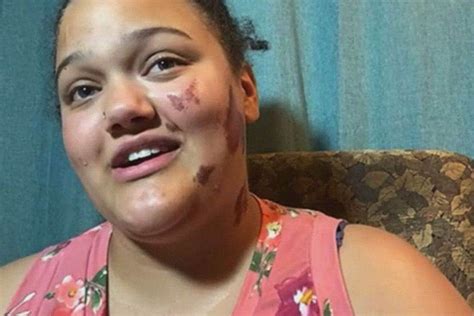 Althea Bernstein Emotionally Talks Being Set On Fire By White Men In