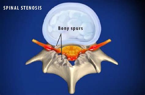 Lumbar Radiculopathy 3 Stl Misc