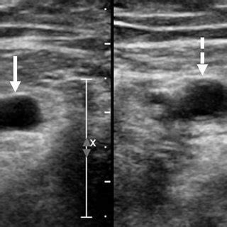 Anterior Accessory Saphenous Vein AASV And The Alignment Sign A Download Scientific
