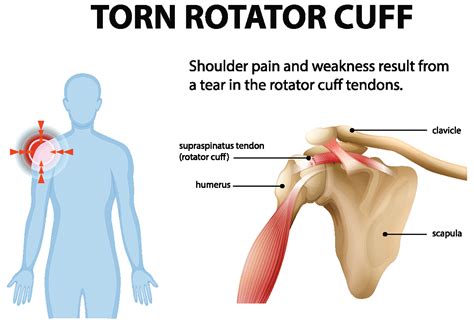 Rotator Cuff Repair Orlando