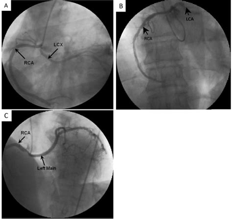 A Left Anterior Oblique View Showing Anomalous Left Circumflex LCX Download Scientific