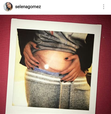 Selena Gomez Operasi Transplantasi Ginjal