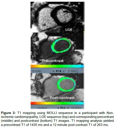 Diffuse Interstitial Myocardial Fibrosis By T1 Myocardial Mapping