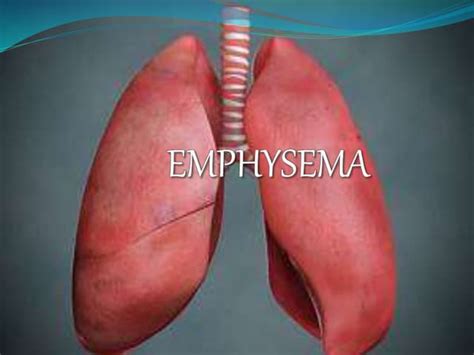 Emphysema Pptx