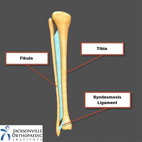 High Ankle Sprain Joi Jacksonville Orthopaedic Institute