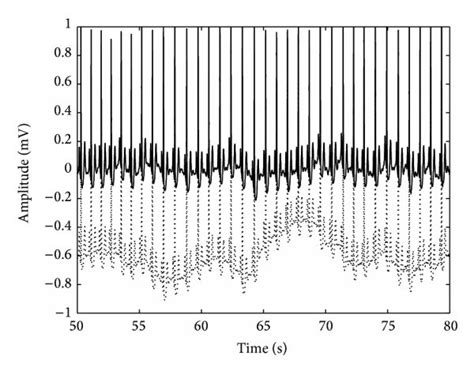 Illustrations Of An Ecg Recording With A Large Baseline Drift Bottom Download Scientific