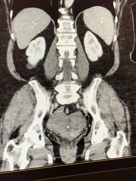 Sex Life Rhysterectomy