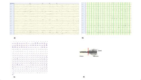 steps of analysis a high density eeg signal on which spindles are