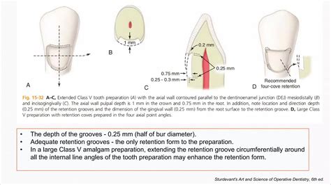 Class 5 Cavity Designs Pdf