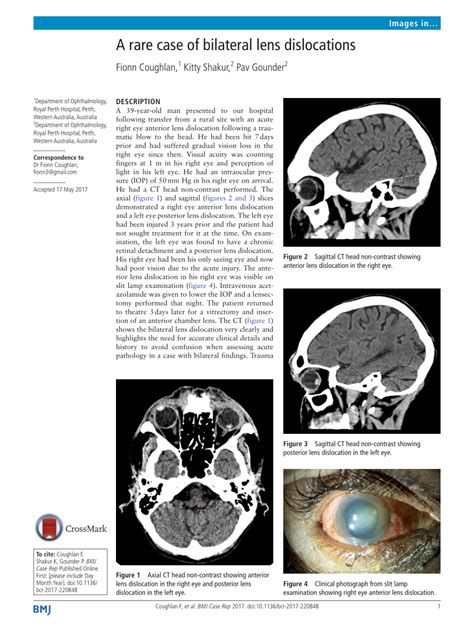Pdf A Rare Case Of Bilateral Lens Dislocations