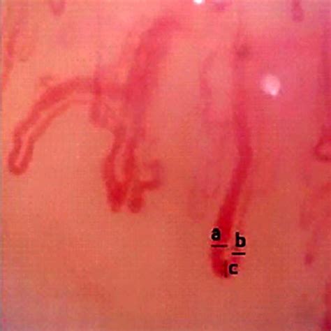 A And B Show Giant Capillary And Bleeding Areas Of Pv Patients
