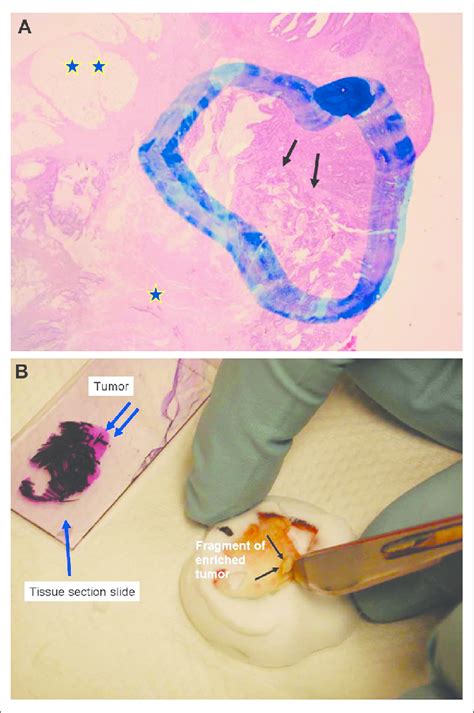 A The Pathologist Selects The Tissue Block Most Representative Of The