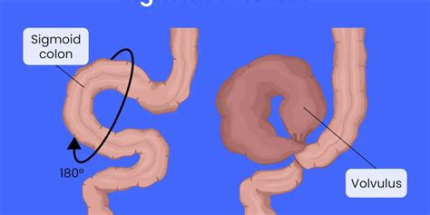 Twisted Colon Volvulus Everything You Need To Know
