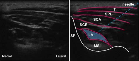 Multifidus Cervicis Plane Block Is Effective For Cervical Spine Surgery
