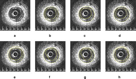 Image Analysis Techniques For Automated Ivus Contour Detection Ultrasound In Medicine And Biology